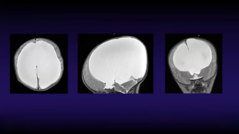 Ventriculoperitoneal Shunt Replacement - A Complete Guide to Procedure ...