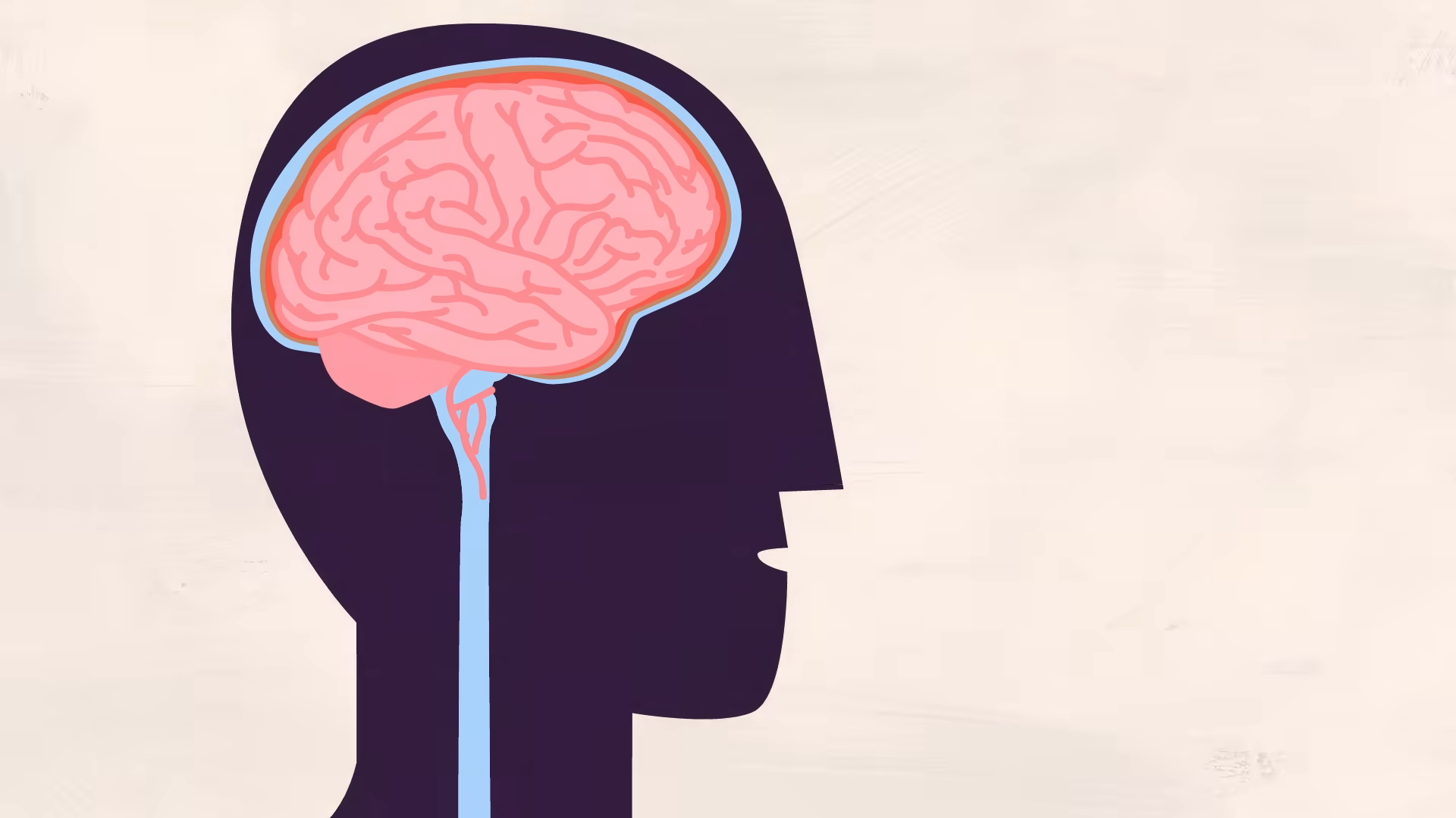 Ventriculoperitoneal Shunt Replacement - A Complete Guide to Procedure ...